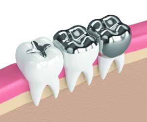 Amálgama na odontologia, entenda sobre! - 100fronteiras.com